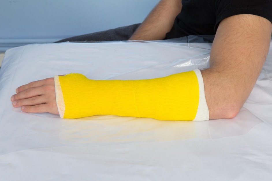 Below Elbow Conventional – Benecare Medical